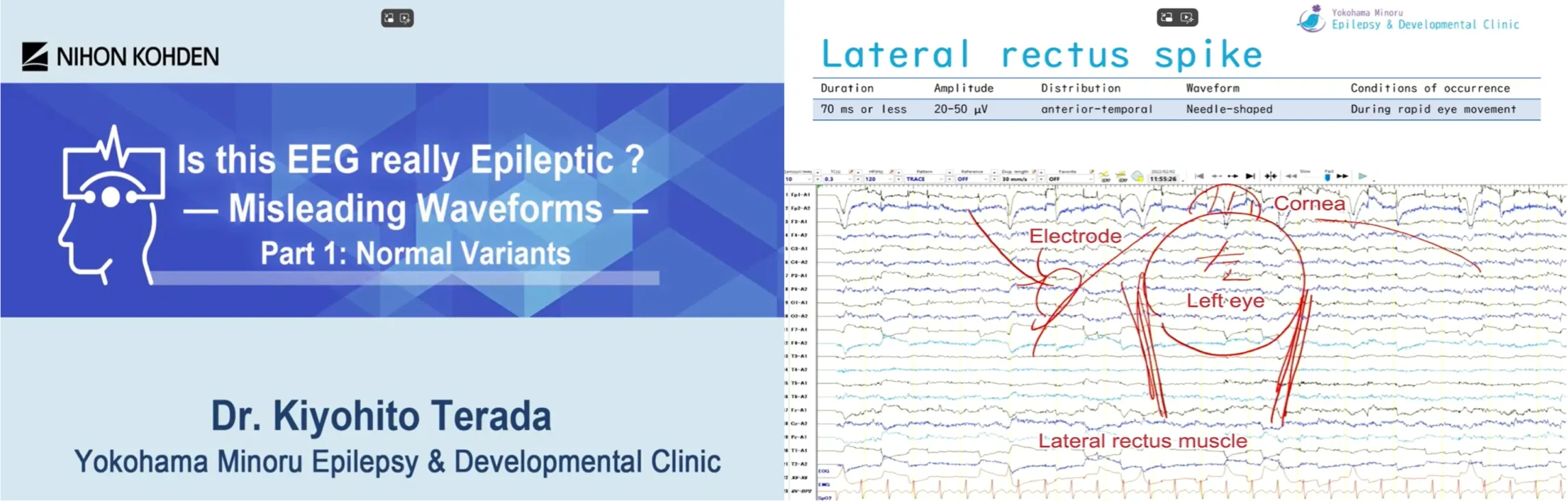 Final lecture: Digital EEG Webinar 4 (Part 1 & 2) Released | Nihon Kohden Korea